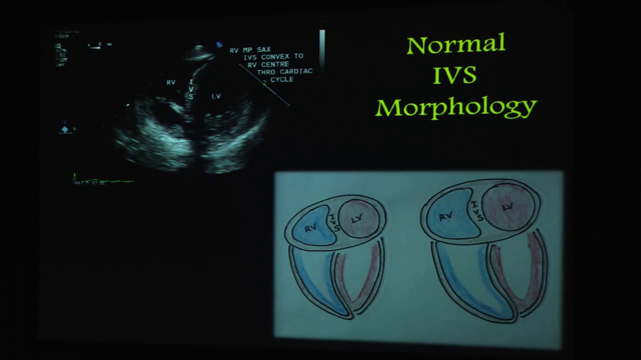 20180824_22_ RV_function_assessment_by_echocardiography_ Kumar_C_Dr - YouTube