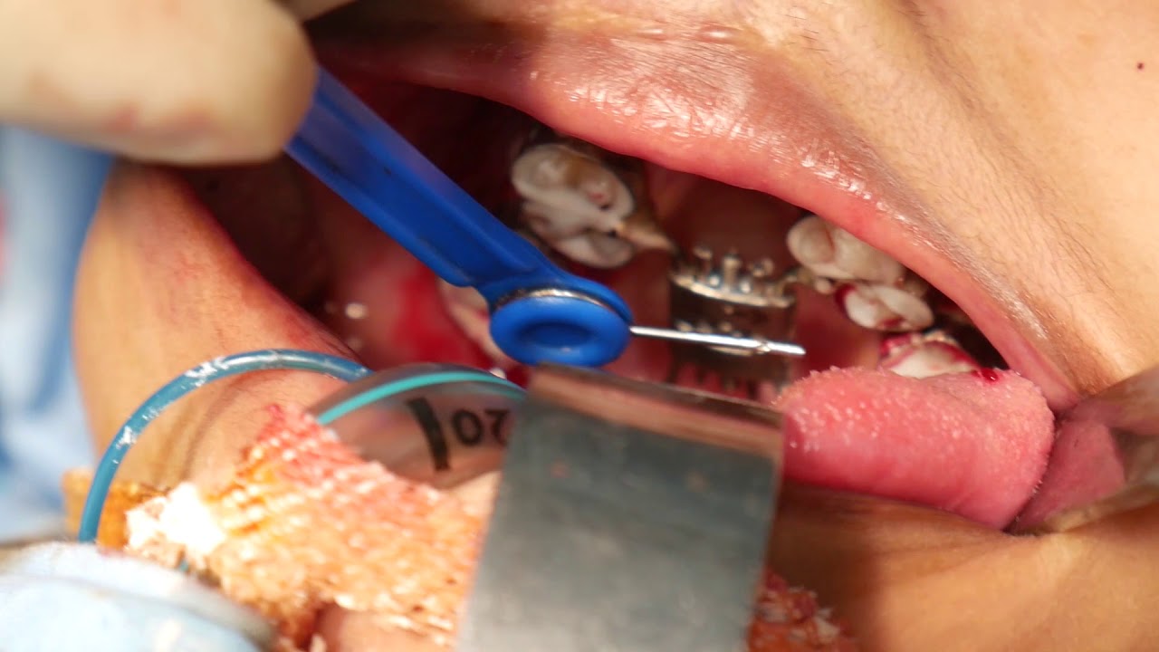 Anterior maxillary distraction in India treatment of severe maxillary ...