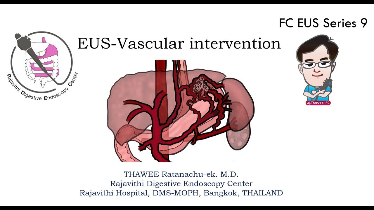 FC EUS Series 9 vascular intervention - YouTube
