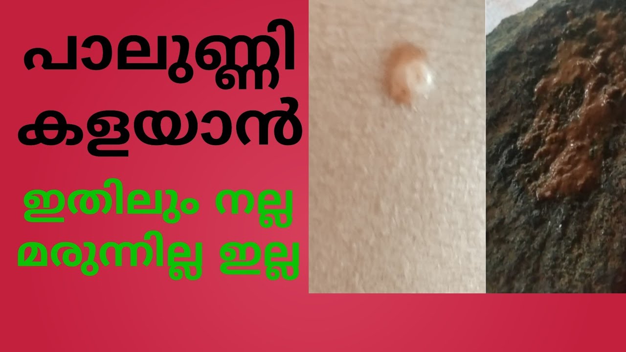 How to remove palunni in malayalam useful tips - YouTube