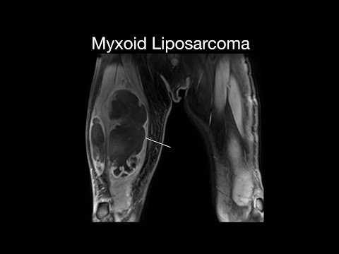 Myxoid Liposarcoma