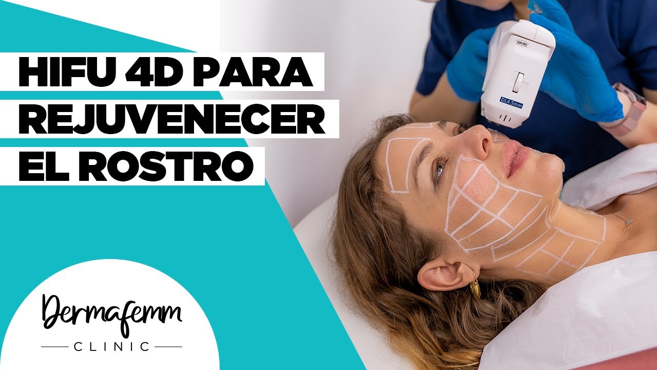 HIFU 4D FACIAL PARA REJUVENECER EL ROSTRO - Aplicación en Nuestra Amiga Antonella - YouTube