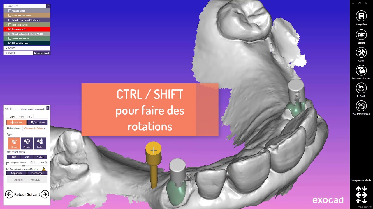 Inlay Core avec exocad - YouTube