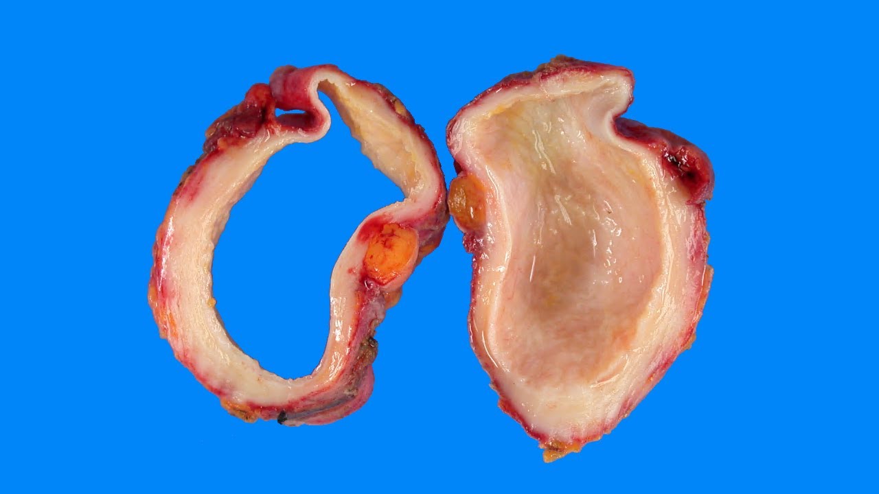 Retroperitoneal cyst 2 - paracolic or peripancreatic, unilocular cyst ...