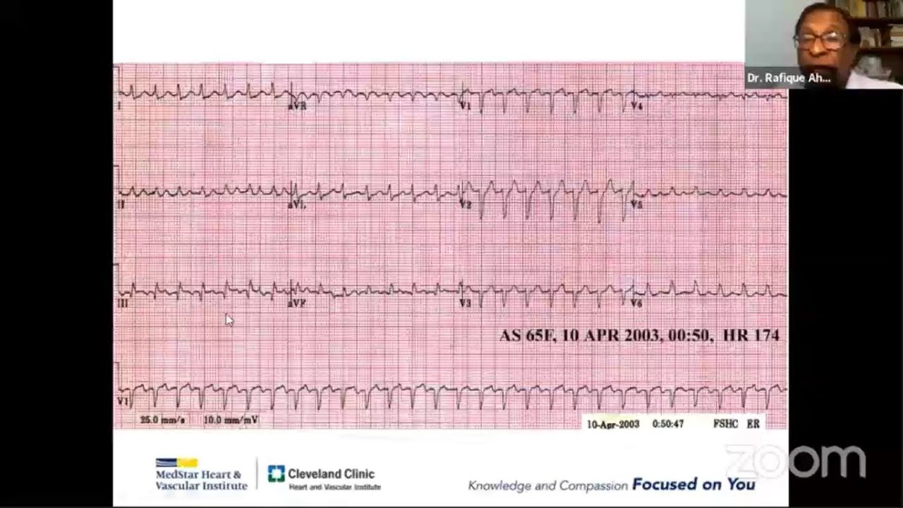 Atrial Tachyarrhythmia - YouTube