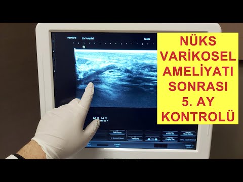 Nüks Varikosel Ameliyatı Sonrası 5. Ay Damarların Kaybolması ve Ağrıların Geçmesi