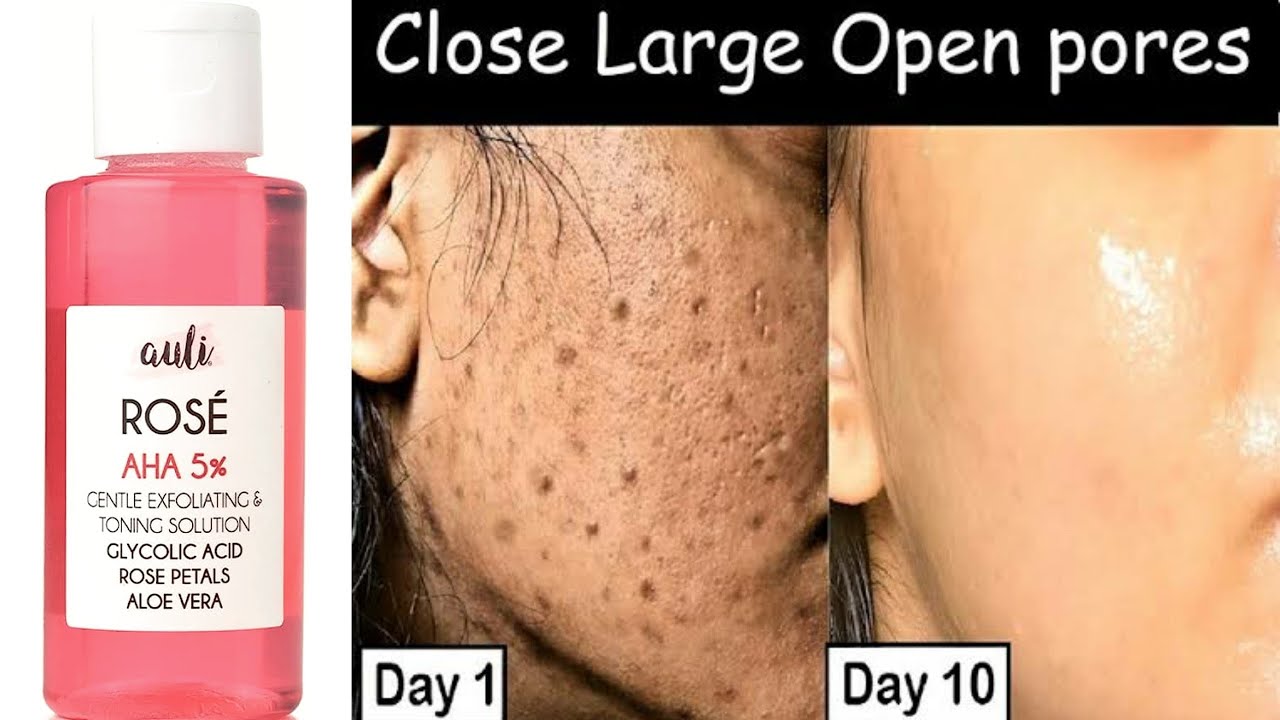 दाग़ धब्बे को जड़ से खत्म करके चेहरे को चमकदार बनाता है| Auli Rose ...