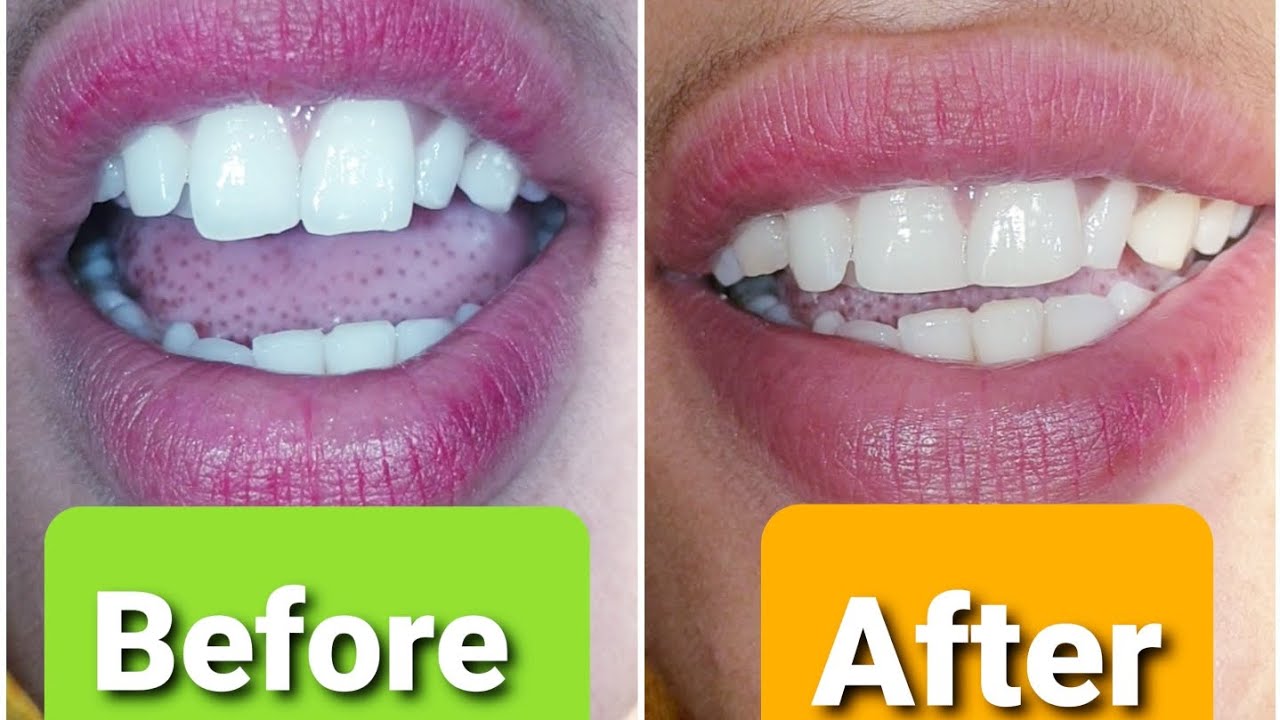 Big teeth Reshaping(Macrodontia) #dentist #big #teeth #reshaping ...