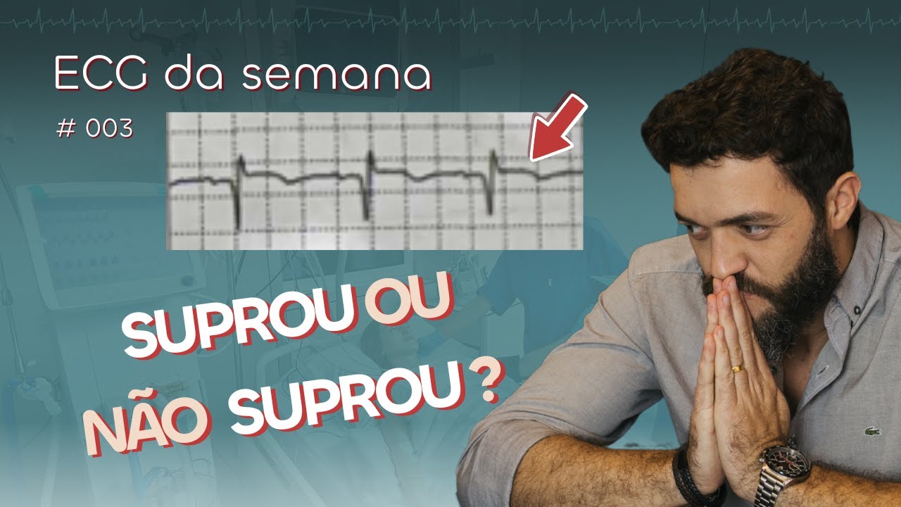 Kardie I ECG da semana 003: Supra de ST limítrofe - YouTube