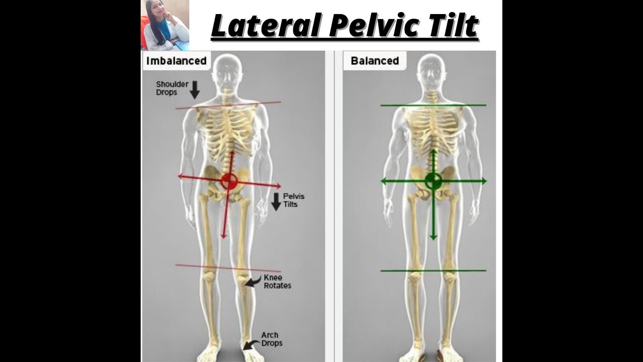 LATERAL PELVIC TILT / HIP COMPLEX BIOMECHANICS - YouTube