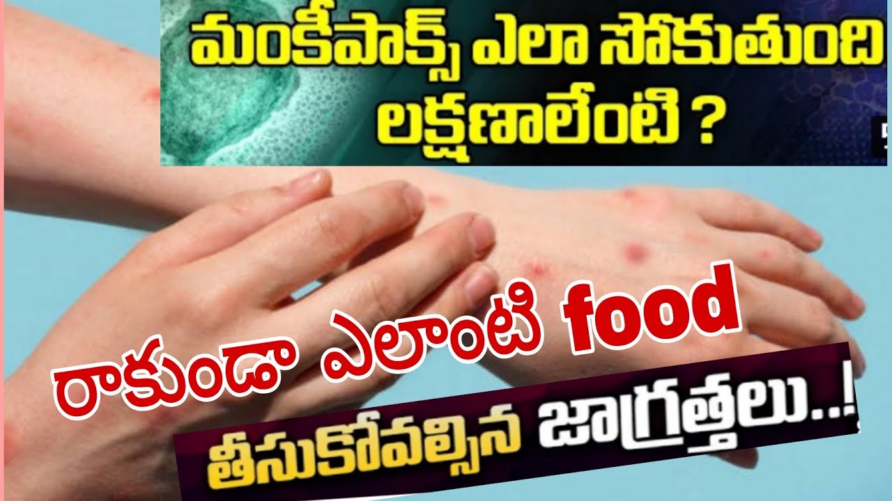 How to Avoid Monkeypox Through Food / Monkeypox Symptoms / Monkeypox ...