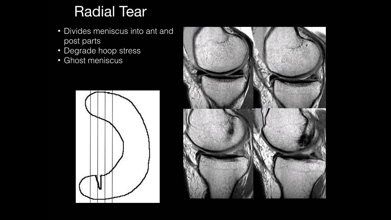 Knee Menisci by Geoffrey Riley, M.D. - YouTube