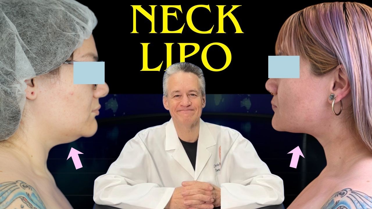 Neck Liposuction Podcast w/ Dr. Katzen - YouTube
