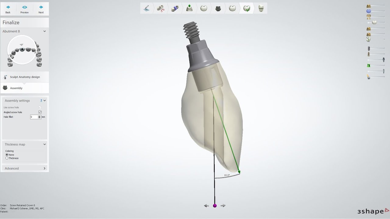 Changing the Angle of Implant Screw Channels Using Digital Design ...