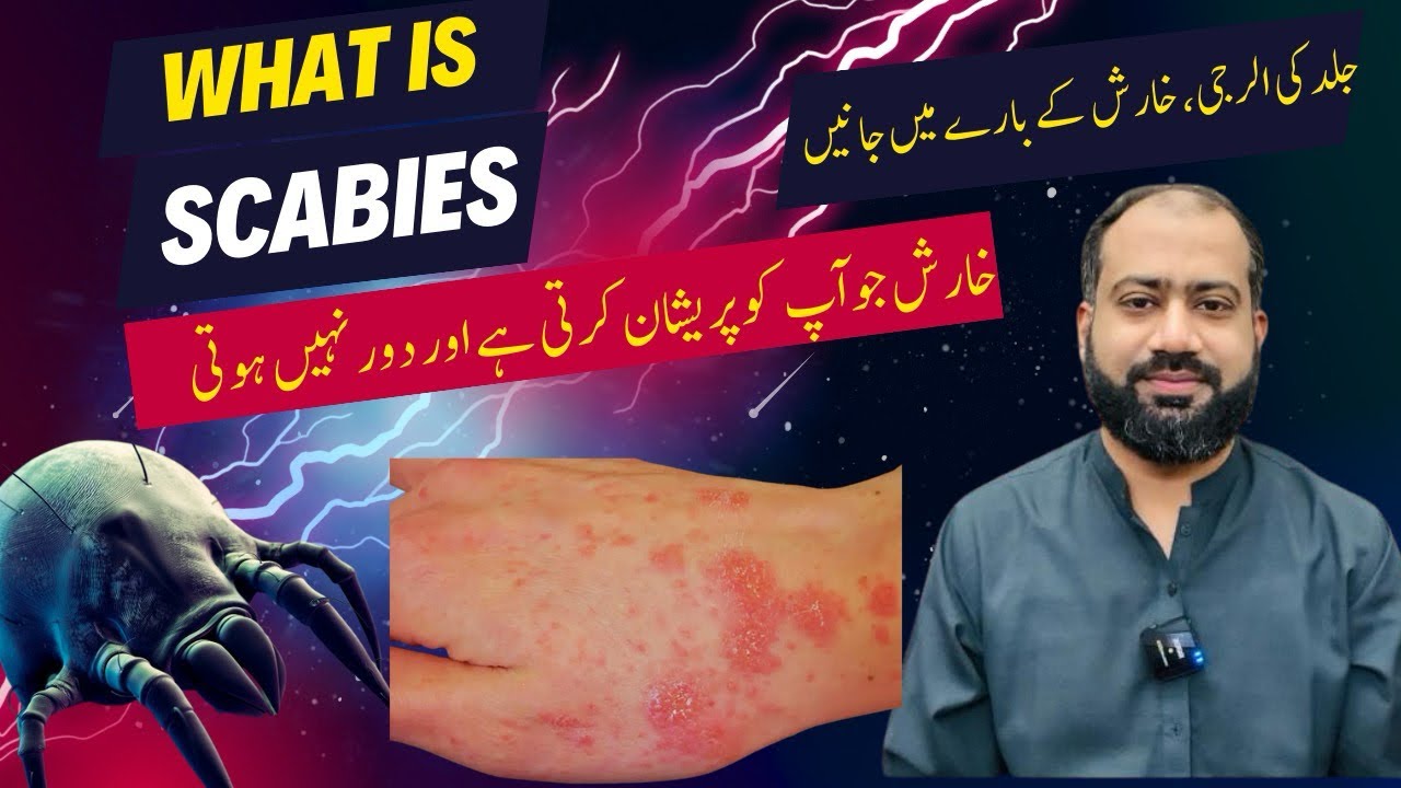 Scabies in Urdu | Kharish Ka ilaj | Skin allergy ka ilaj | Skin itching ...