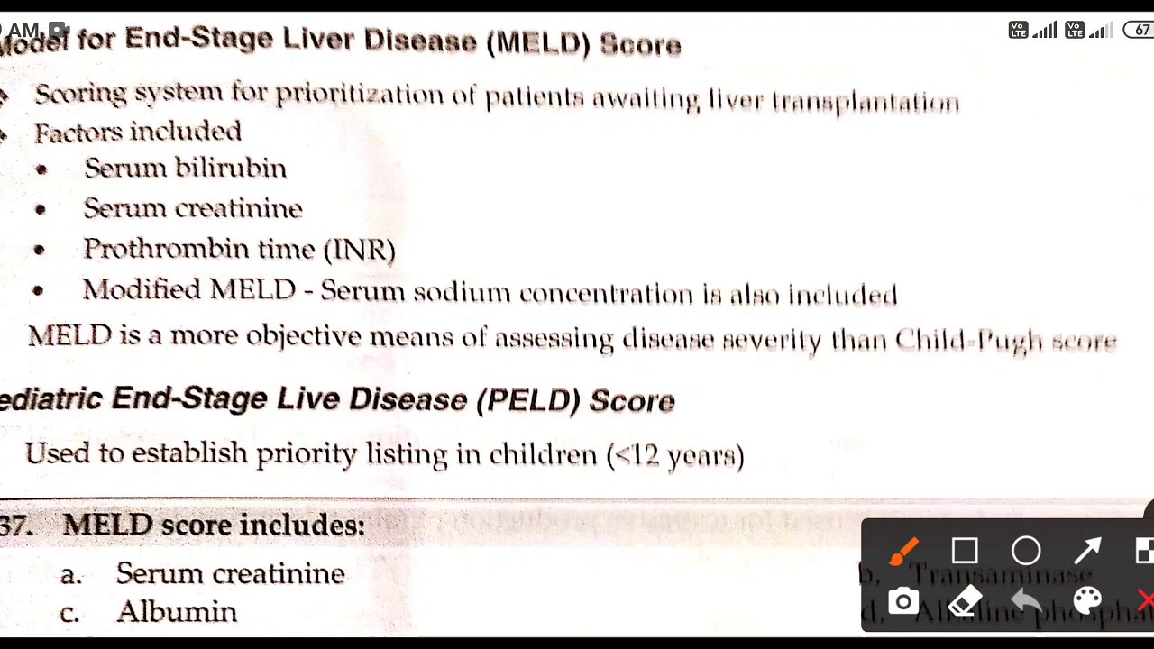 Model for end stage liver disease score with mcq - YouTube