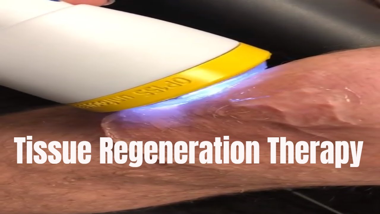 Tissue Regeneration Therapy AKA "TRT" AKA "Stem Cell Machine" AKA ...