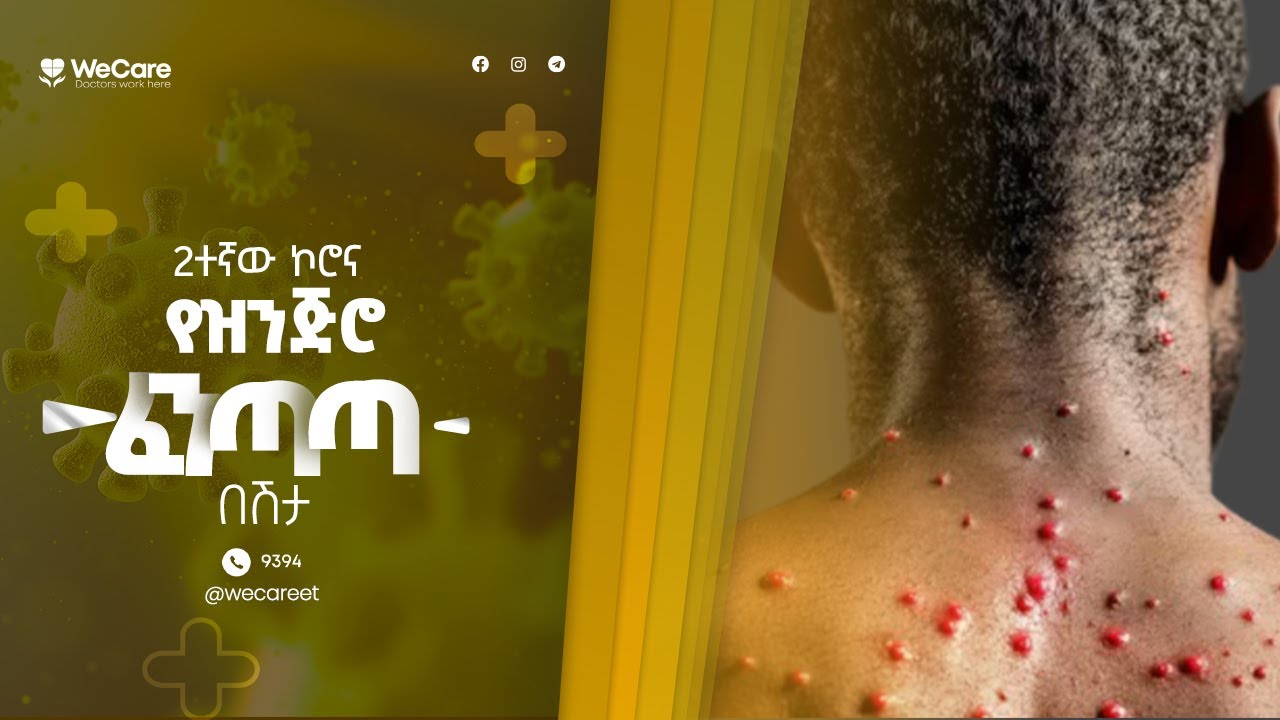 አሳሳቢው የዝንጀሮ ፈንጣጣ (Is monkey pox the new pandemic ) #monkey #pandemic ...