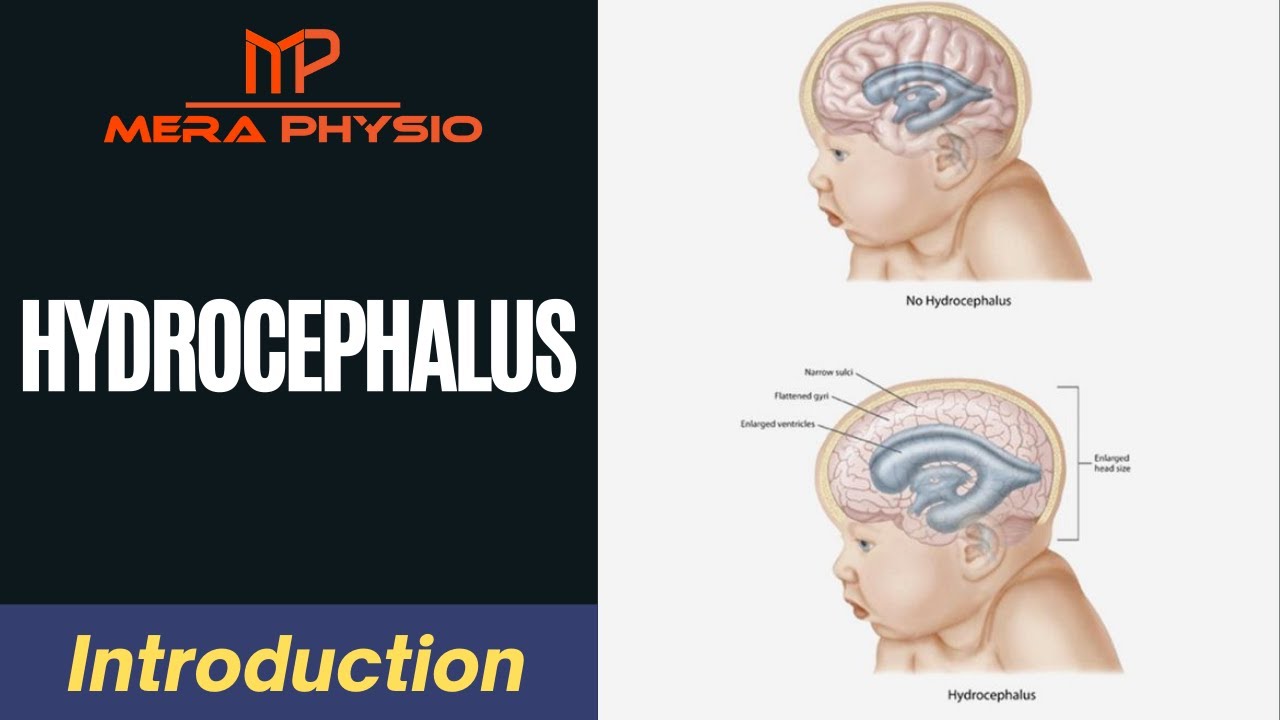Hydrocephalus | Introduction | In Hindi | Mera Physio - YouTube