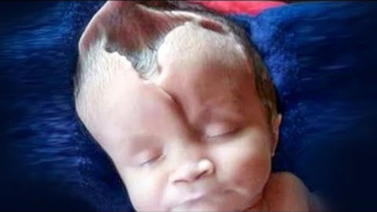 This Baby Was Born Without Part Of The Skull The Whole Medical Staff ...