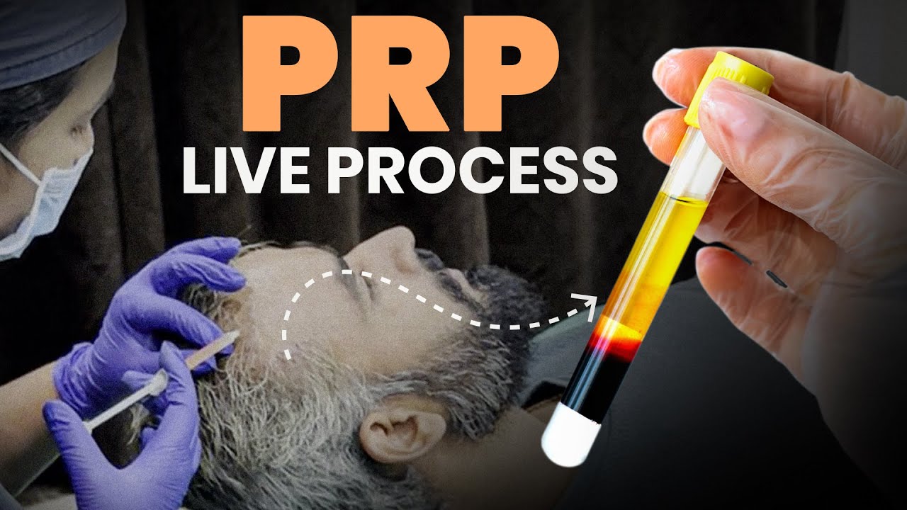 Live PRP Therapy Process: Witness the Power of Platelet-Rich Plasma ...