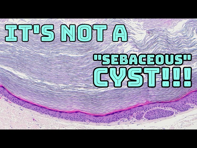 Epidermoid Cyst Sebaceous Cyst Histology