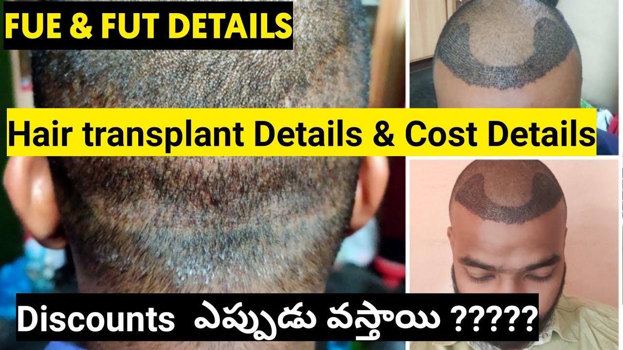 Technique details FUE vs FUT || Cost Details || Discount Details Hair ...