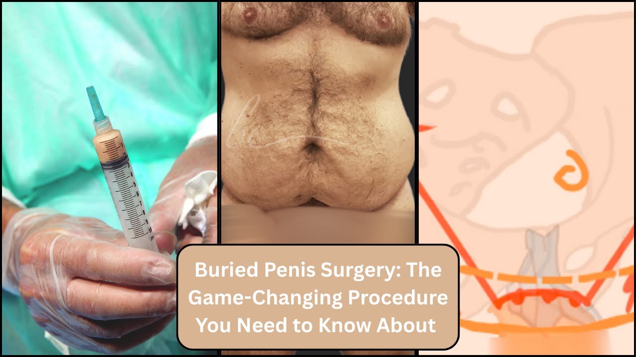 Uncovering Hidden Length: Buried Penis Treatment - YouTube