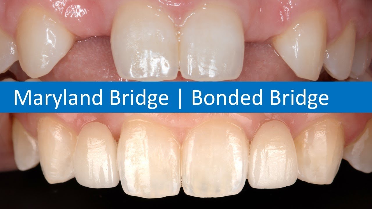 Single Wing Bonded Bridge / Maryland Bridge / Dental Implant ...