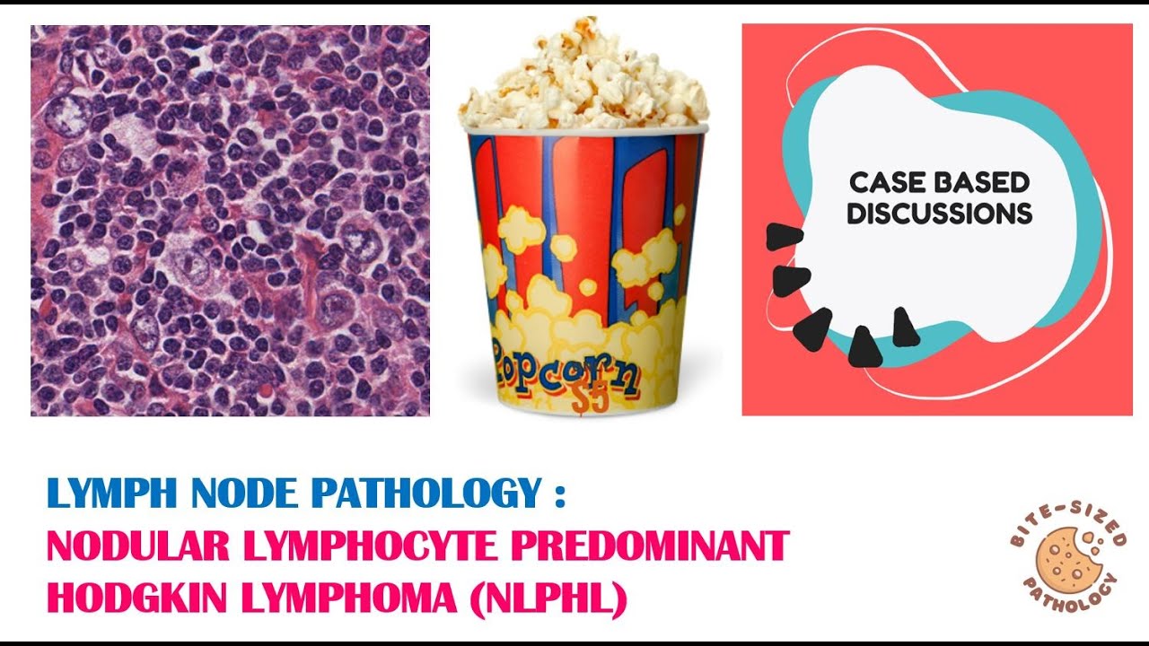 Lymph node pathology - Nodular lymphocyte predominant Hodgkin lymphoma ...