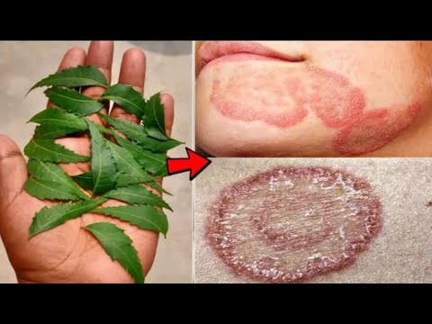 दाद खाज खुजली कि 7 दिन में छुट्टी कर देगा | fungal infection treatment ...