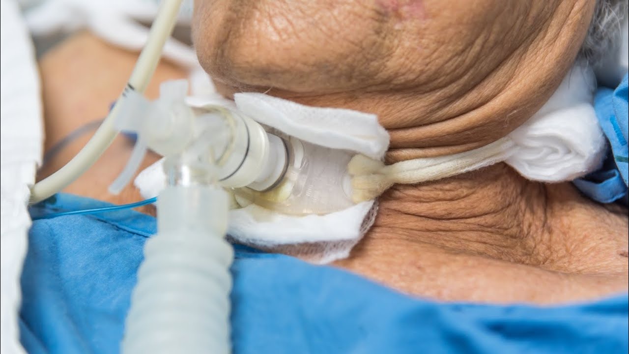 सांस लेने मे समस्या #Tracheostomy #Procedure by 3D #animation # ...