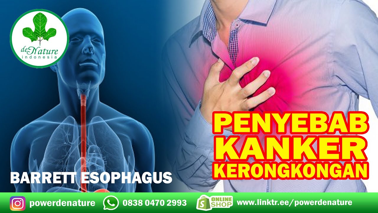 ( BARRETT ESOPHAGUS ) Penyebab Kanker Kerongkongan - Penyakit Yang ...