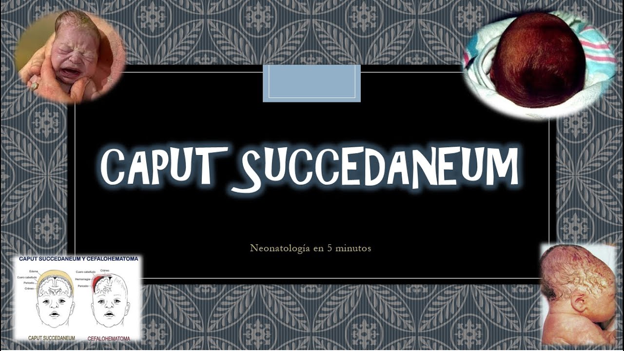 CAPUT SUCCEDANEUM - YouTube