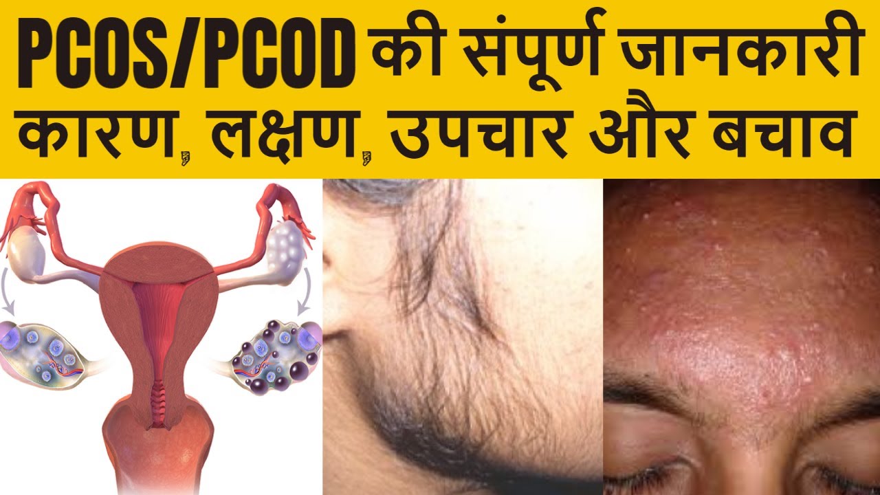 PCOD kya hota hai? PCOS symptoms and treatment I Home Remedies, Preventive Tips, Causes,PCOD ...