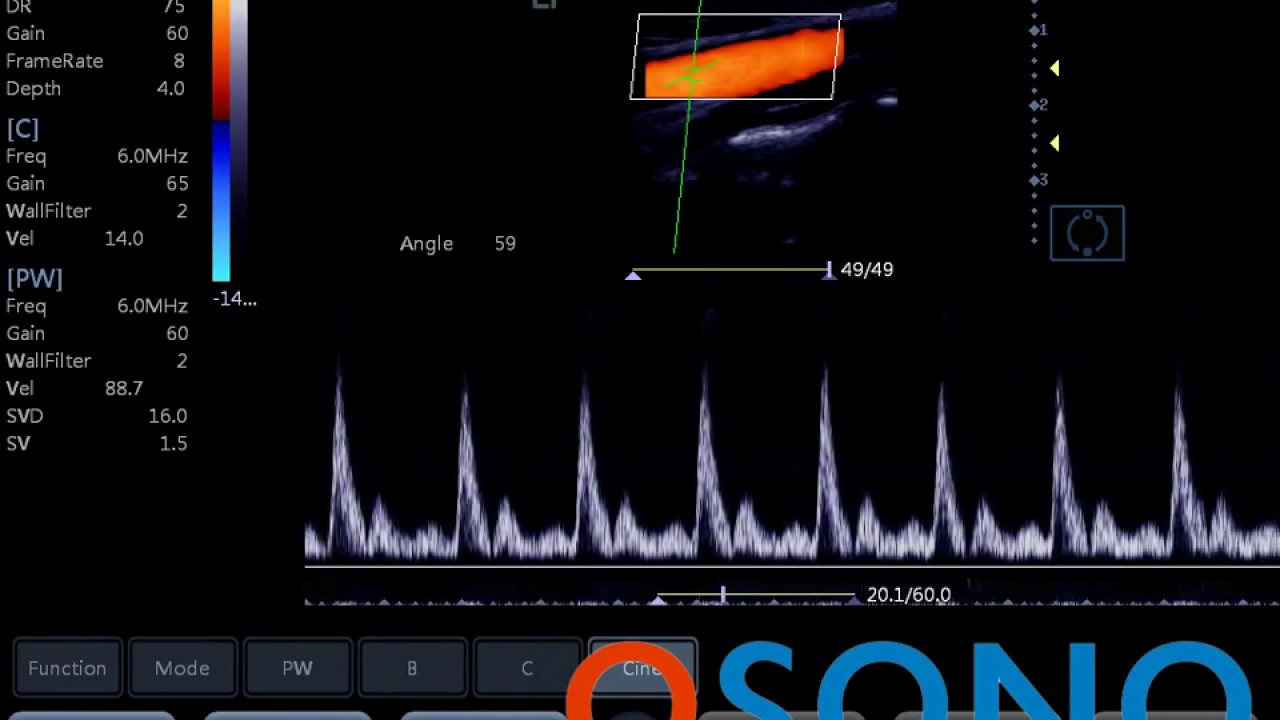 Clinical Exported Videos Wireless Pocket Ultrasound Linear Probe for ...