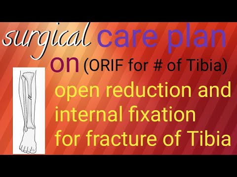 surgical care plan on open reduction and internal fixation for fracture ...