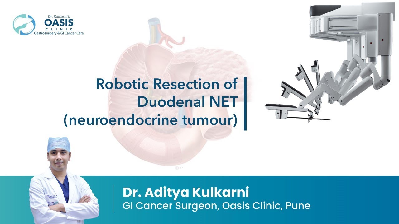 Robotic Resection of Duodenal Neuroendocrine Tumour | Dr. Aditya ...