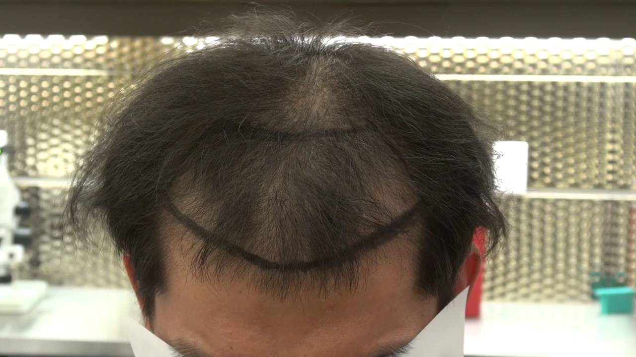 San Francisco Hair Loss Treatment for Balding Asian Men Dr. Diep www ...