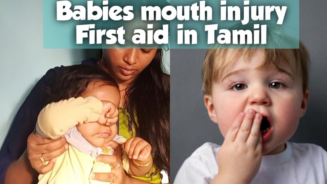 Babies Mouth Injury First Aid In Tamil What To Do When Your Baby Get babies-mouth-injury-first-aid-in-tamil-what-to-do-when-your-baby-get