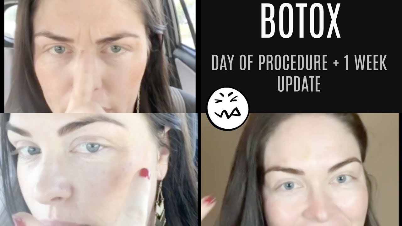 GETTING BOTOX INJECTIONS + 1 WEEK UPDATE ON RESULTS - YouTube