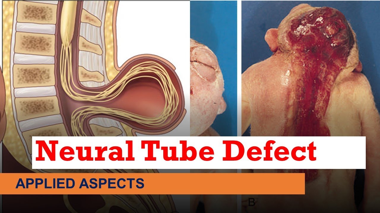 Neural Tube and Neural Tube Defects - YouTube