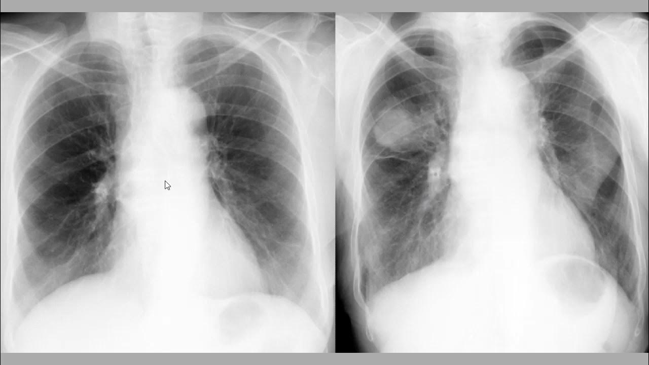 Рак правої легені - YouTube