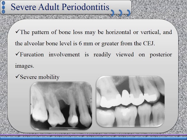 Moderate Periodontitis Radiograph