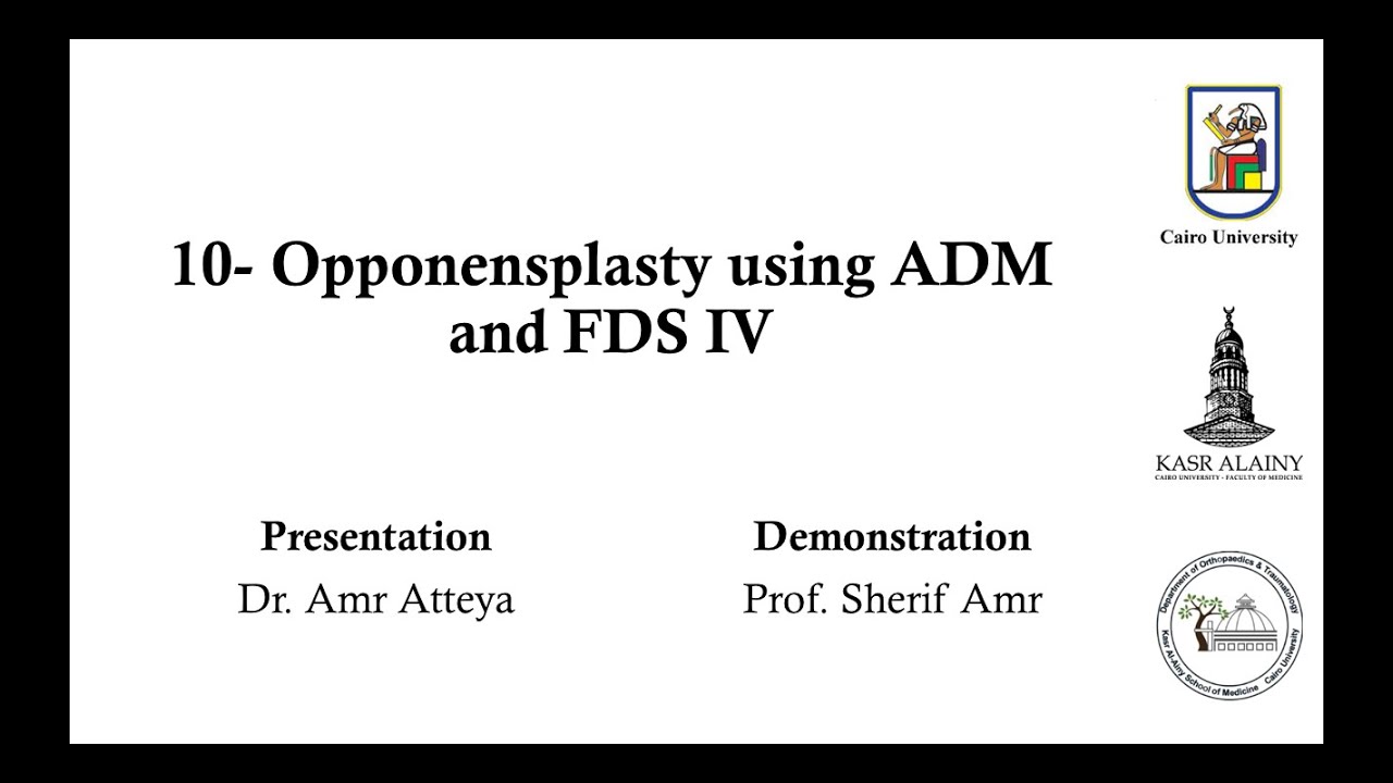 10 Opponensplasty using ADM and FDS IV - YouTube