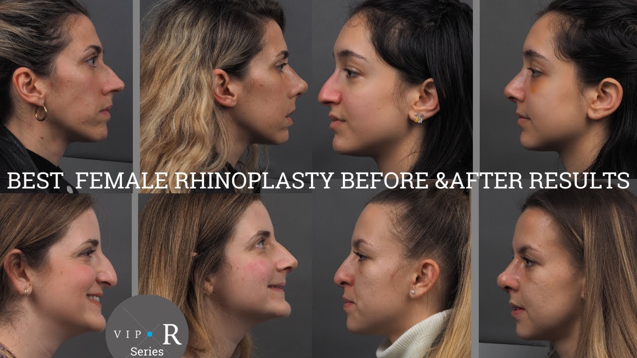 Ρινοπλαστικη πριν και μετα 📷 Rhinoplasty before & after - YouTube