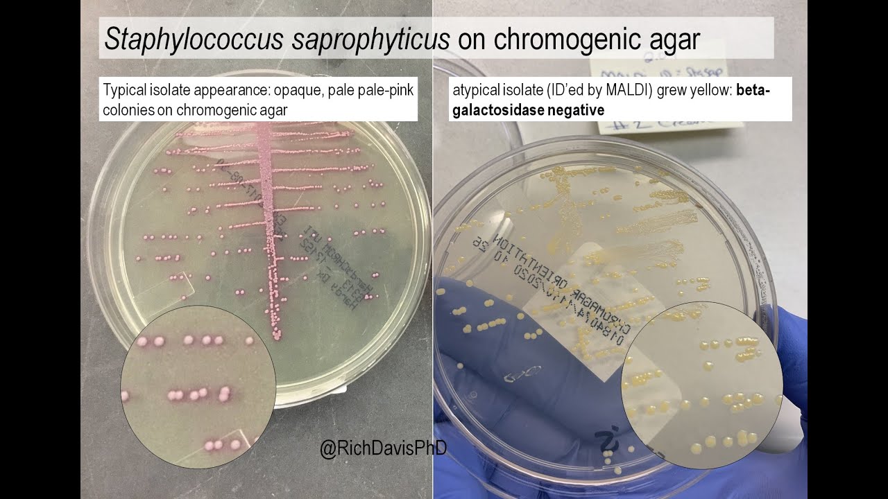 Staphylococcus saprophyticus; A Coagulase Negative Staphylococci ...