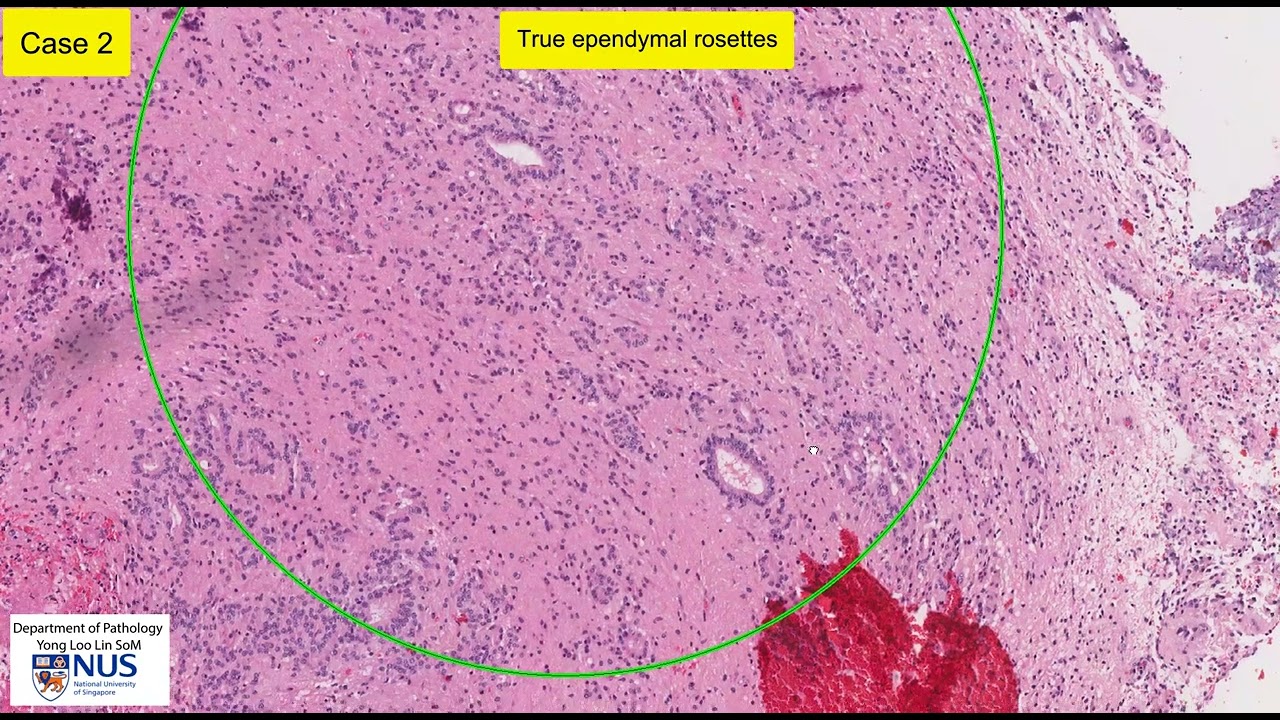 Ependymoma Pathology