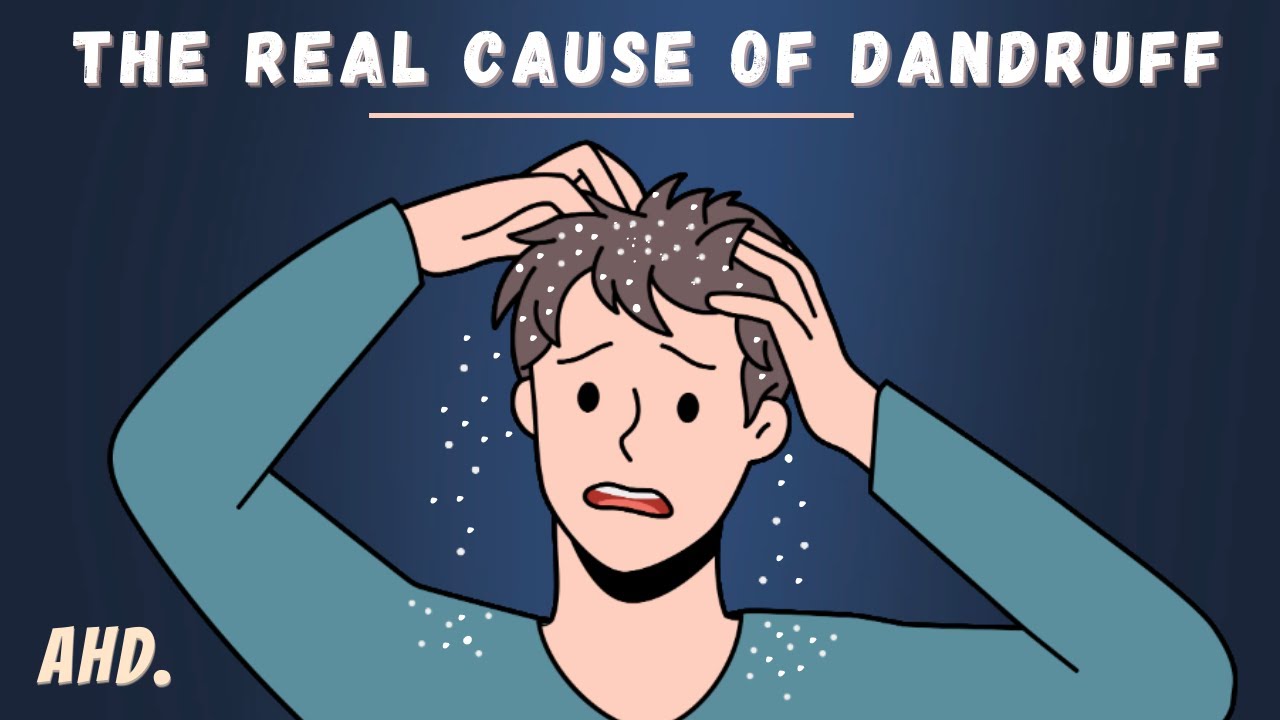 The Real Cause of Dandruff - A Doctor Explains - YouTube