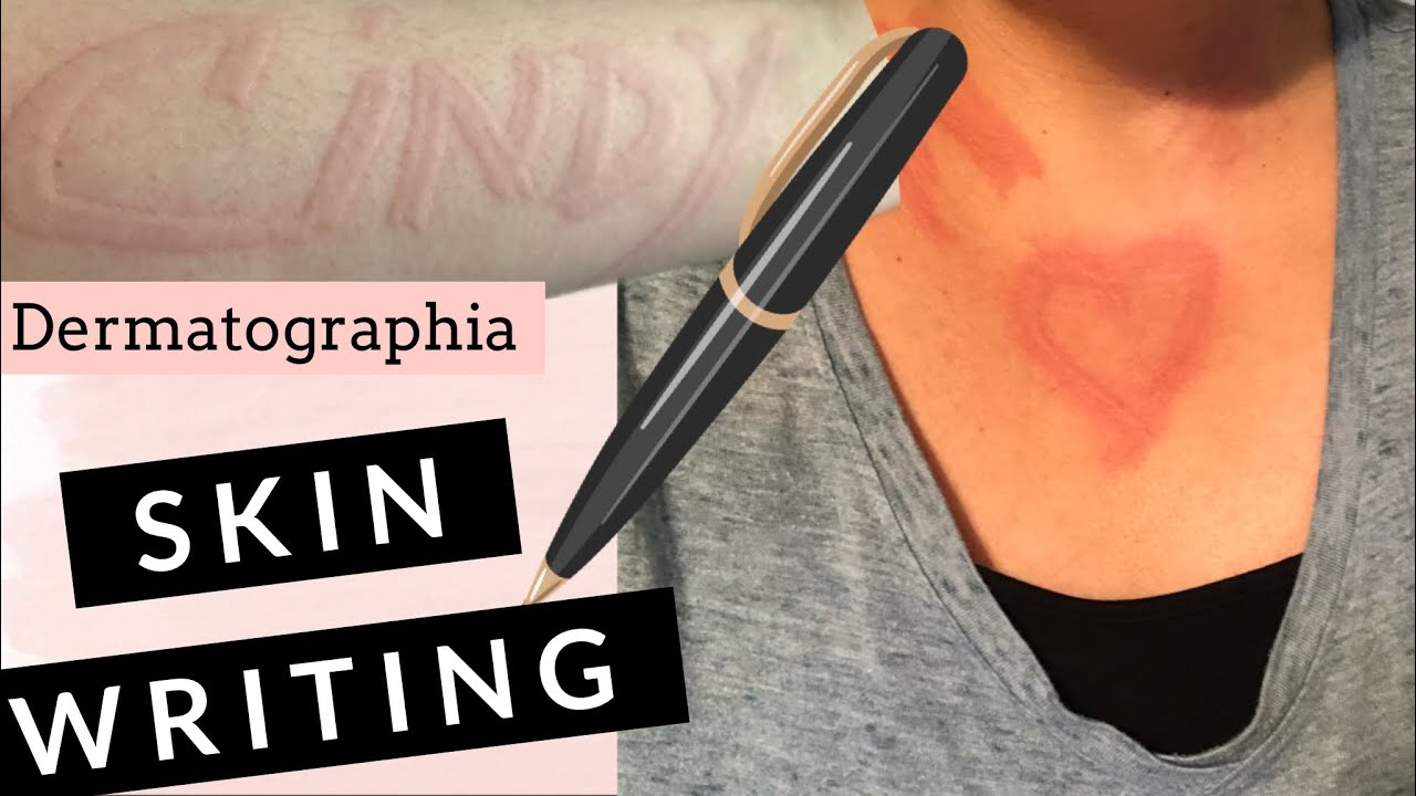 Life With Dermatographia Urticaria/ Skin Writing - YouTube